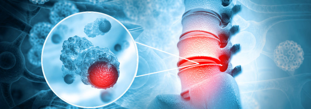 How Spinal Cord Injuries Affect the Body | The Law Offices of Scott Sobol